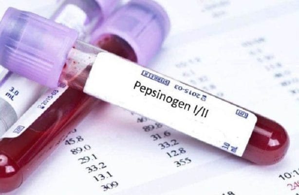 Xét nghiệm viêm dạ dày và ung thư dạ dày Pepsinogen 1 và 2 - Trung tâm xét nghiệm huyết học ...